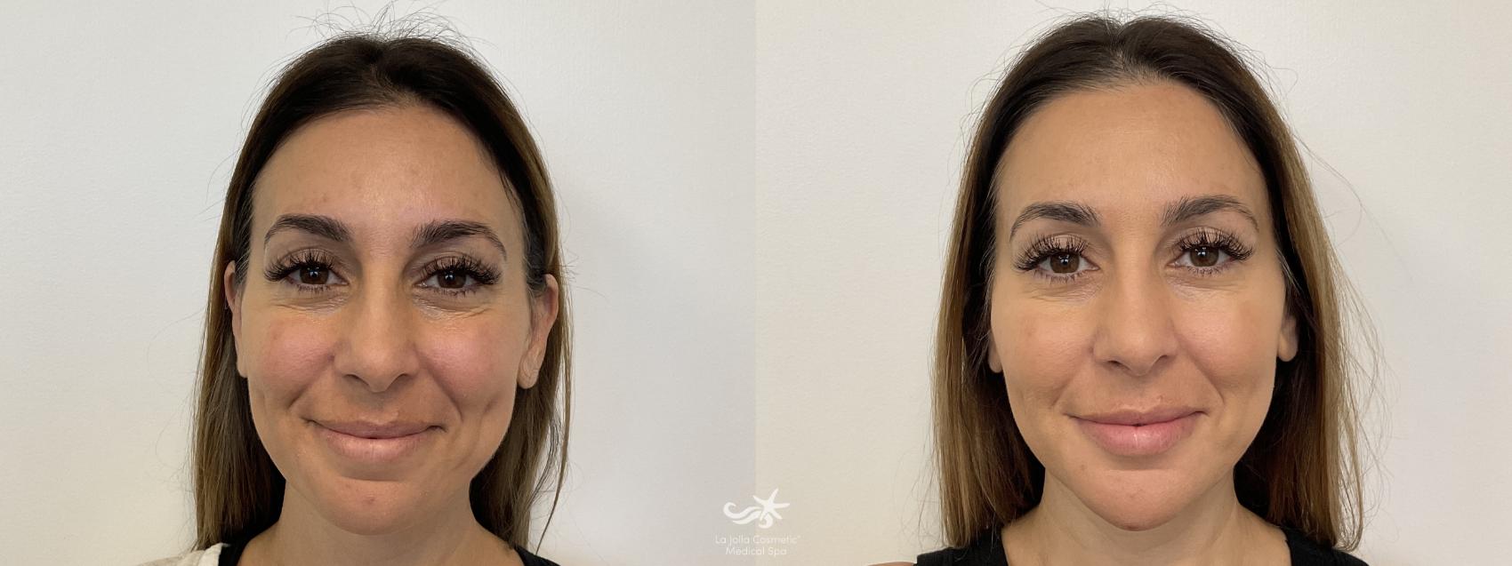 BOTOX® Cosmetic for San Diego, Carlsbad & Temecula | La Jolla Cosmetic ...