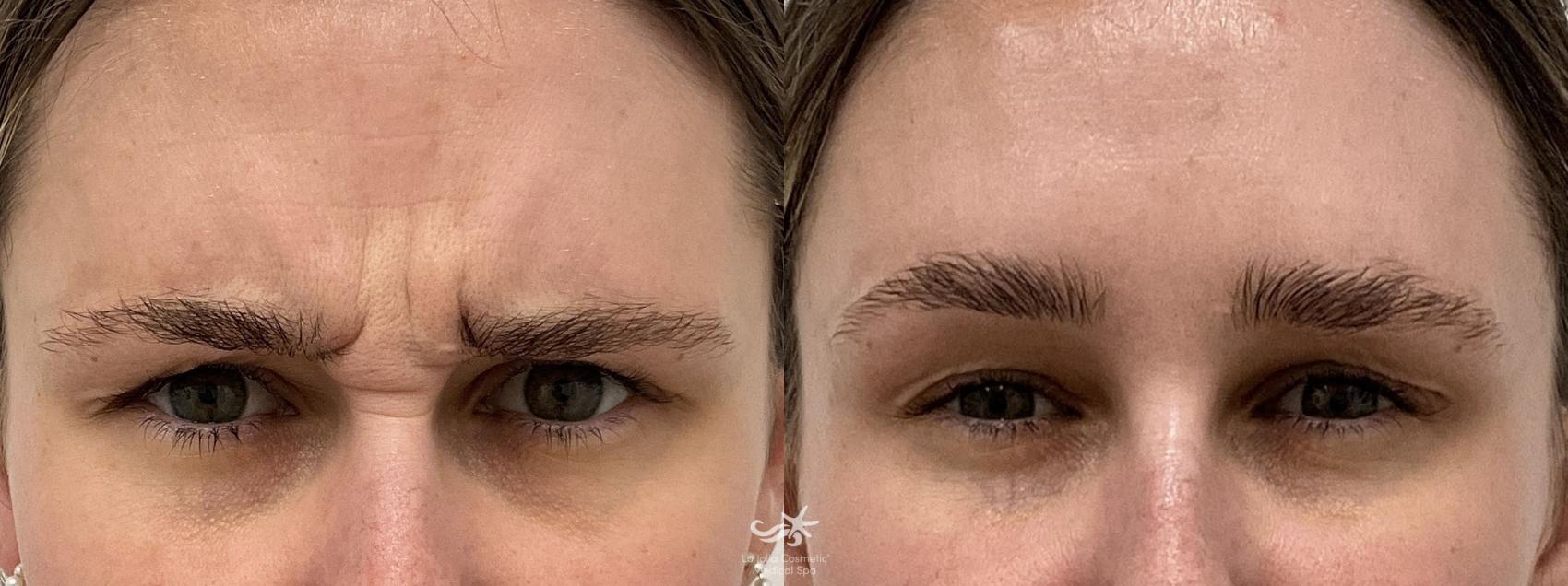 BOTOX® Cosmetic in San Diego & Carlsbad, CA | La Jolla Cosmetic Medical Spa